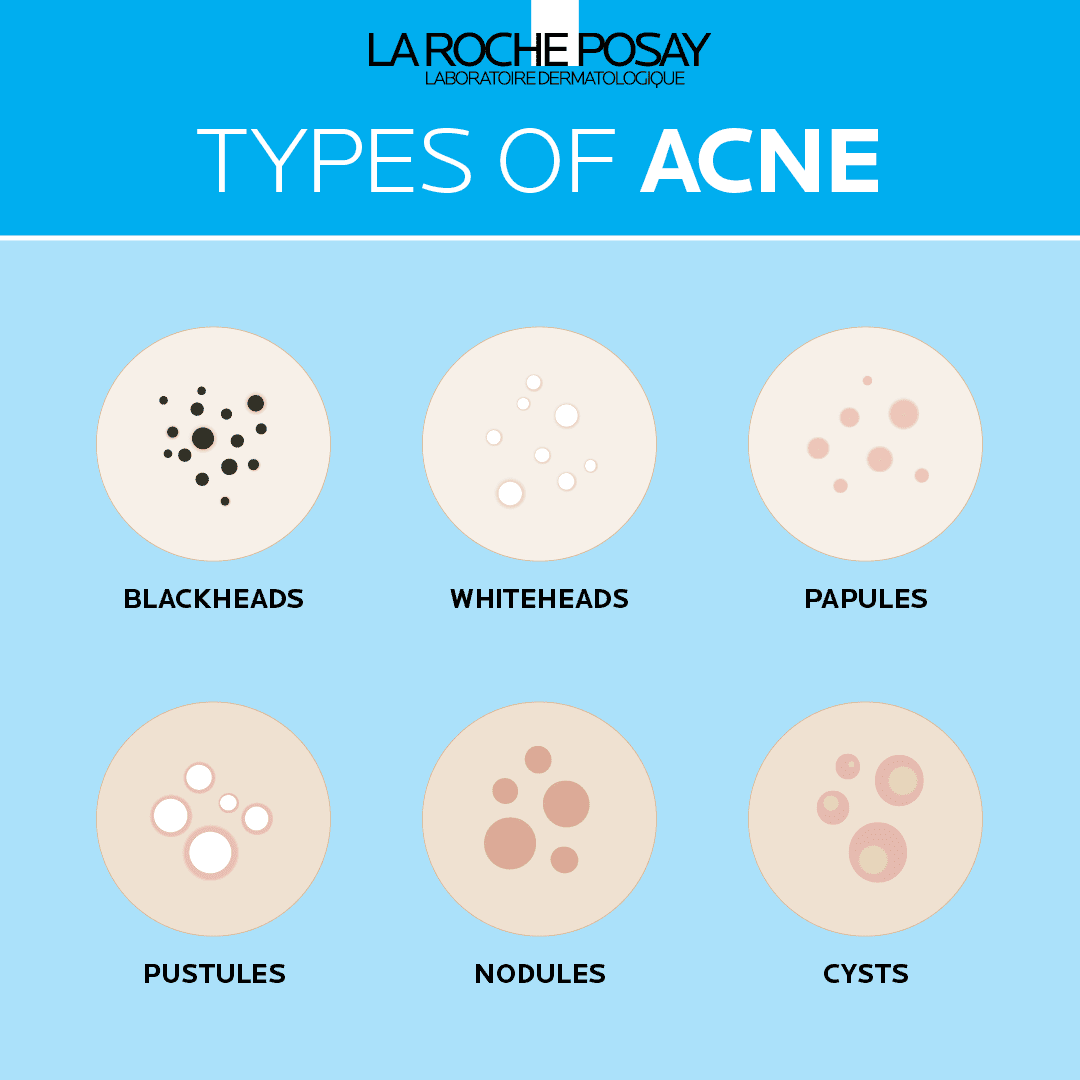Difference Between Acne vs Pimples | La Roche-Posay® Australia & NZ Difference Between Acne vs Pimples | La Roche-Posay® Australia & NZ